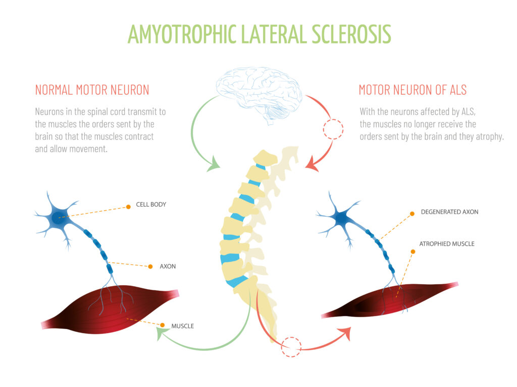 A new way to detect ALS in patients - WMNF 88.5 FM